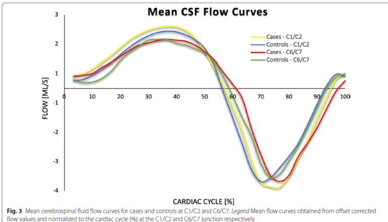 MRI findings in MVC and non MVC necks. CSF Flow…Difference ...