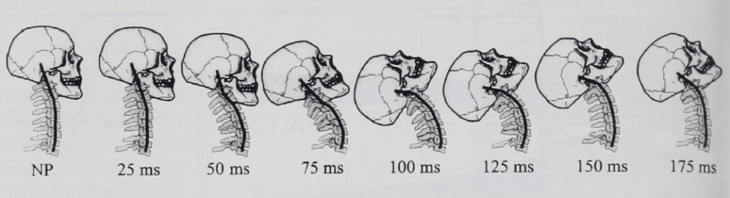 Whiplash Produces a S shaped curve – Professionally Integrated Care
