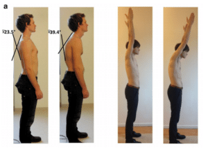 Increased Thoracic Kyphosis and Decreased Shoulder ROM – Professionally ...