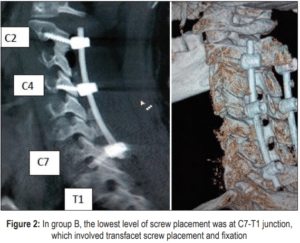 Loss Of Lordosis and Surgery to fix For LONG TERM Outcomes ...