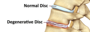 Disc Degeneration and Abnormal Structure and Stability – Professionally ...