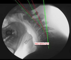 Instability Leading to Cervical Spondylotic Amyotrophy – Professionally ...