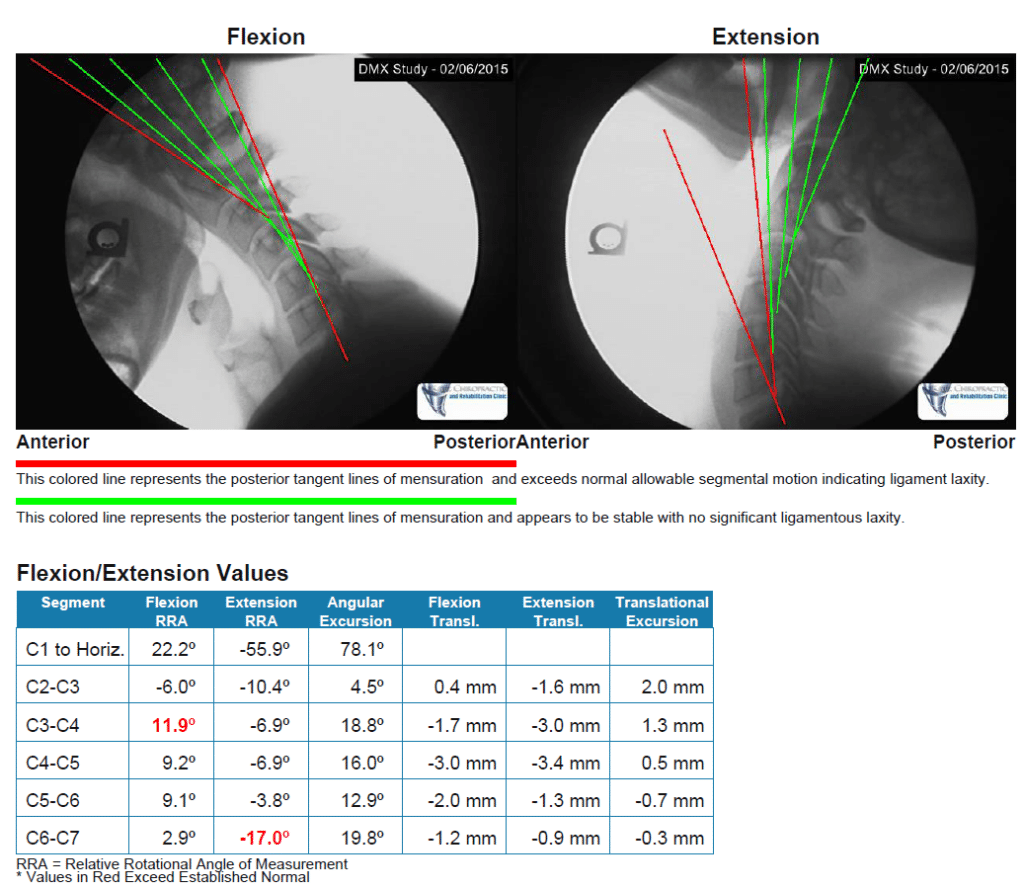Documenting cervical instability on flexion and extension ...