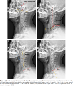 Basilar Invagination and cervical Alignment! – Professionally Integrated Care